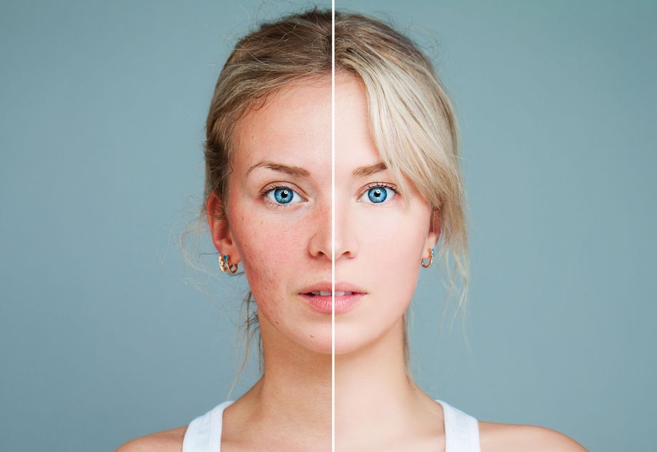 Iho-oireet, joita ei kannata sekoittaa akneen