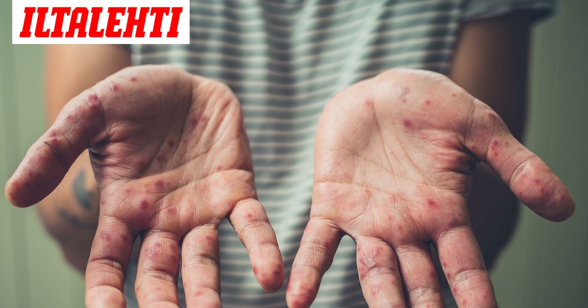 Tuhkarokko raketoi Venäjällä: Tartuntojen määrä kasvanut 300-kertaisesti