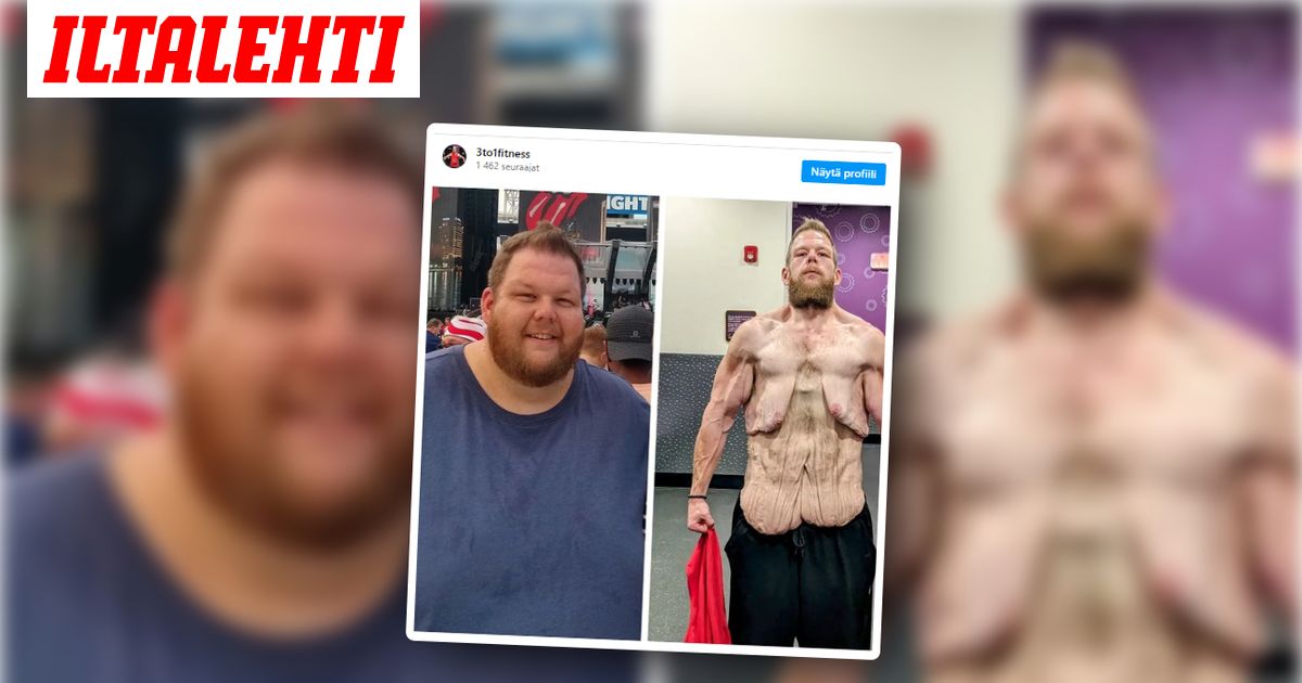 Mies tiputti painoa 160 kiloa – Muodonmuutos lyö ällikällä