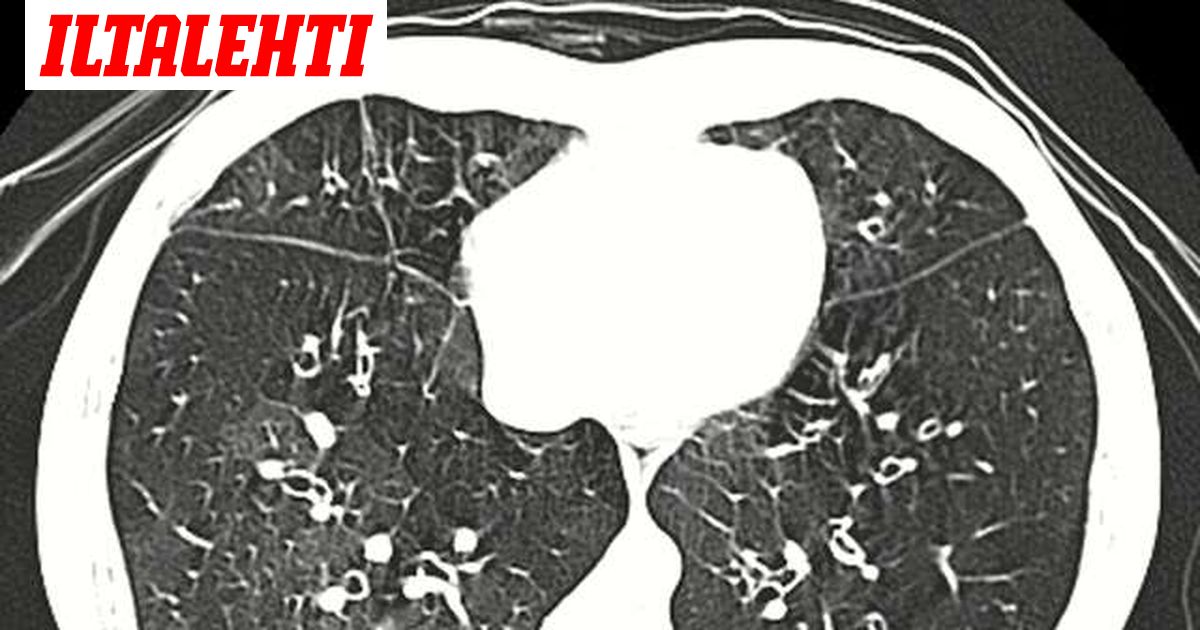 Tällainen on vapen aiheuttama popcorn-keuhko