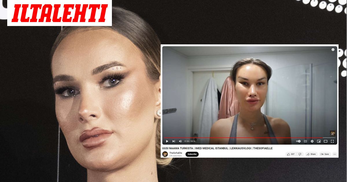 Tältä BB-Sofia Tuomola näyttää 10 päivää kauneusleikkauksen jälkeen – Operaation jälkeinen ...