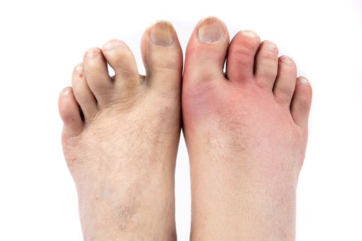 Kihti: oireet, hoito ja ehkäisy