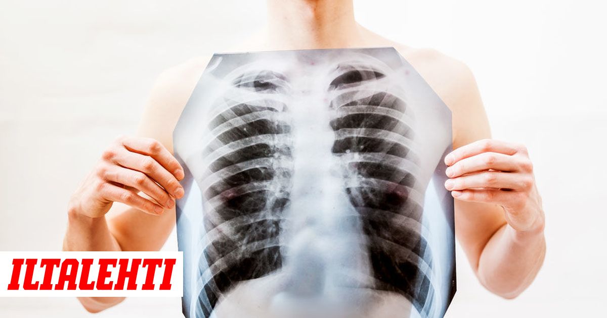 Keuhkosyöpä oireilee koko kehossa - 8 mahdollista oiretta