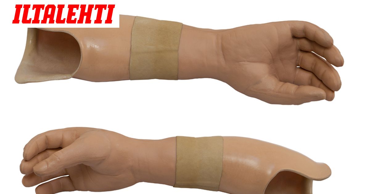 Sotaveteraani sai amputoidun kätensä takaisin - 47 vuotta myöhemmin