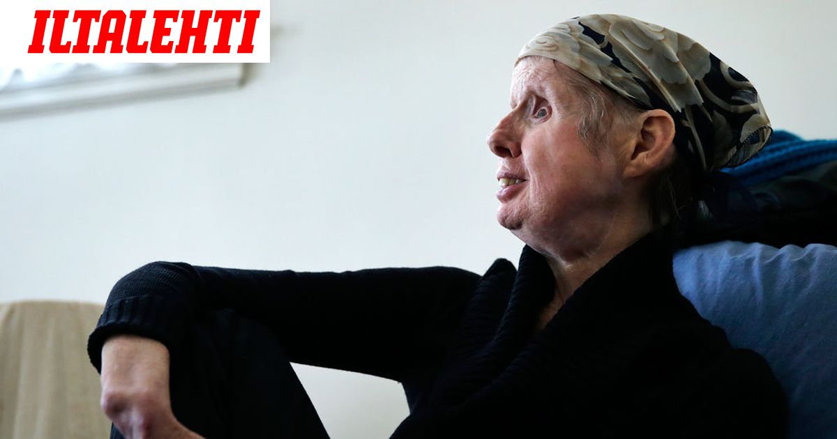 Koskettava kuvasarja toipumisesta: Simpanssi tuhosi Charlan kasvot