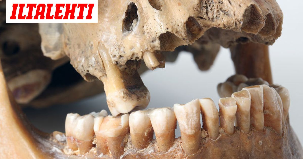 Huonot hampaat lyhentävät elinikää