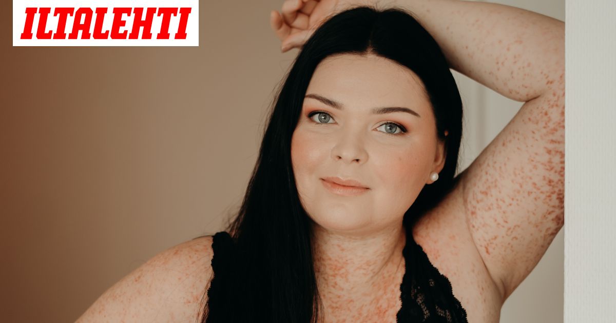 Minnalla, 34, on harvinainen sairaus, joka näkyy hänen ihollaan