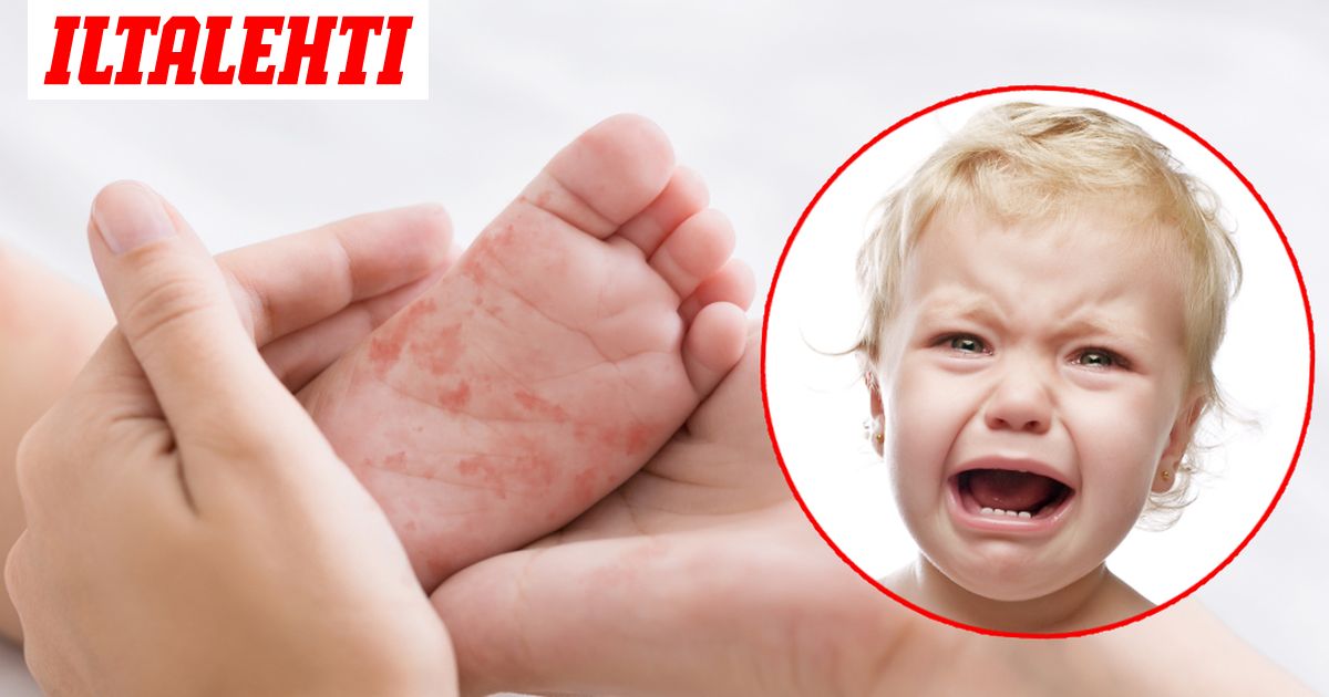 Tuhkarokko tappoi Suomessa eniten lapsia: 115 kuolemaa yhdessä vuodessa