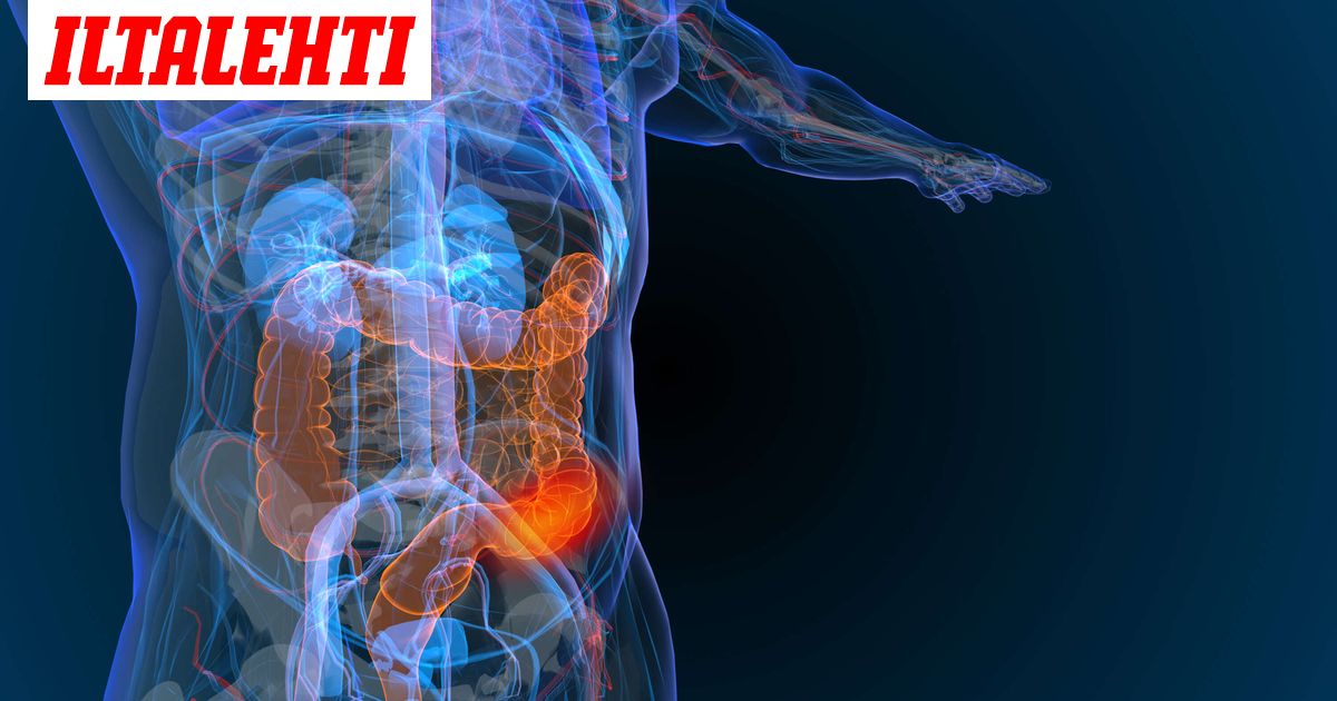 Verikoe voi löytää Suomen toiseksi yleisimmän syövän