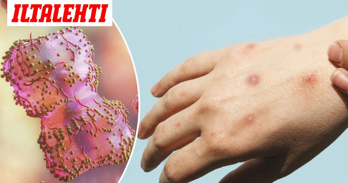 Ihottuma voi olla apinarokon oire: hyvä syy testata