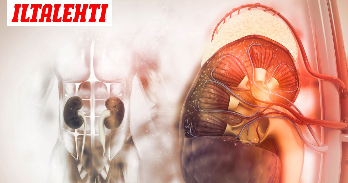 Yleinen munuaistauti etenee vaivihkaa - tunnetko siitä kertovat vaaran ...