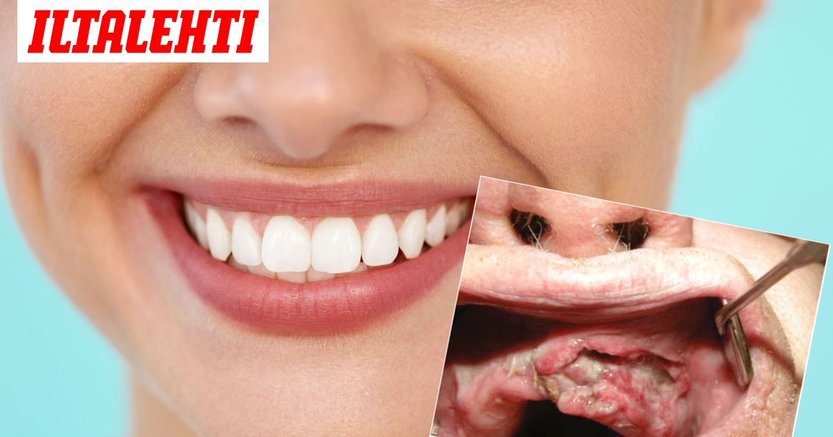 Nuuska ja nuoret: Nuuska tuhoaa suun ihan kokonaan - kuvat ei herkille