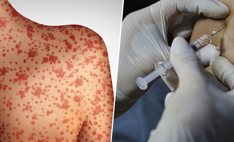 Satakunta: Jo toinen tuhkarokkoepäily - nyt sairastui 4-vuotias