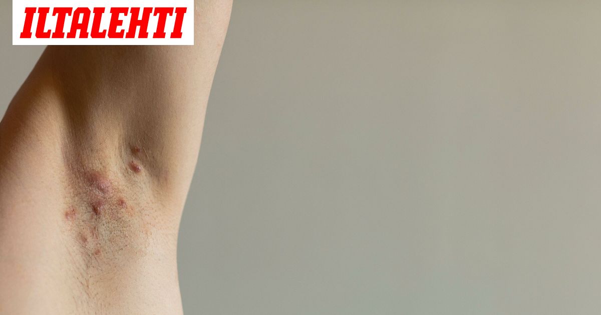 Yhä useammalla on HS-tauti – Tästä tunnistat