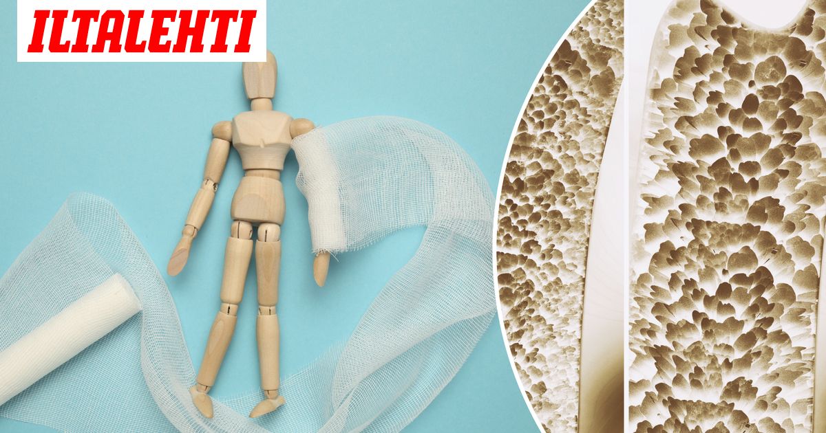 Osteoporoosi: ensimmäinen merkki voi olla rannemurtuma