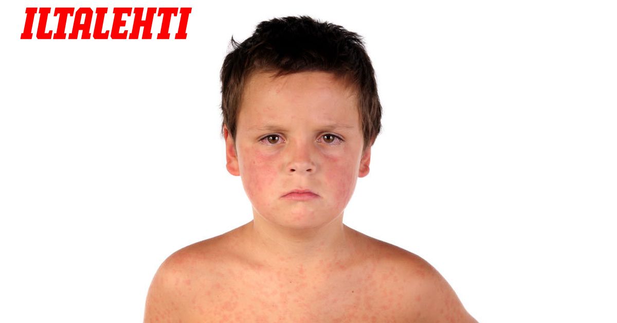 Tuhkarokko leviää Euroopassa - WHO varoittaa