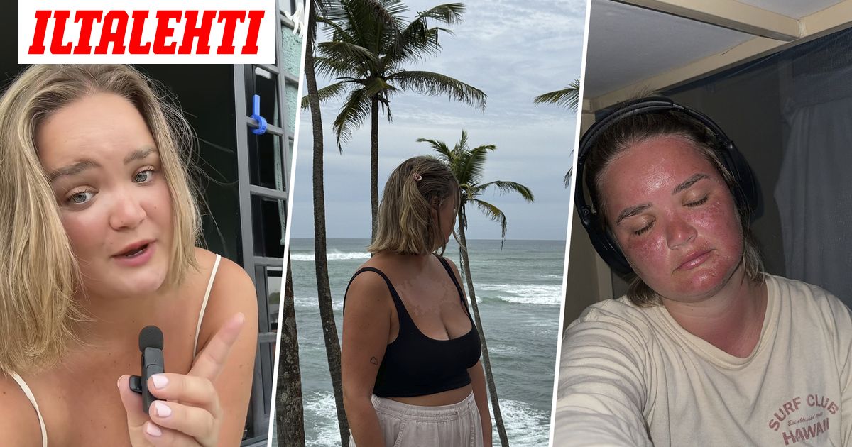 Emma, 24, paloi pahasti auringossa – Varoittaa nyt muita