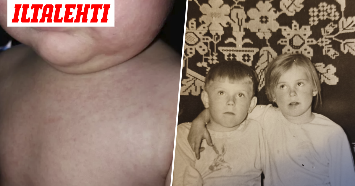 Tällaisia oireita tuhkarokko aiheuttaa – Lukijat kertovat