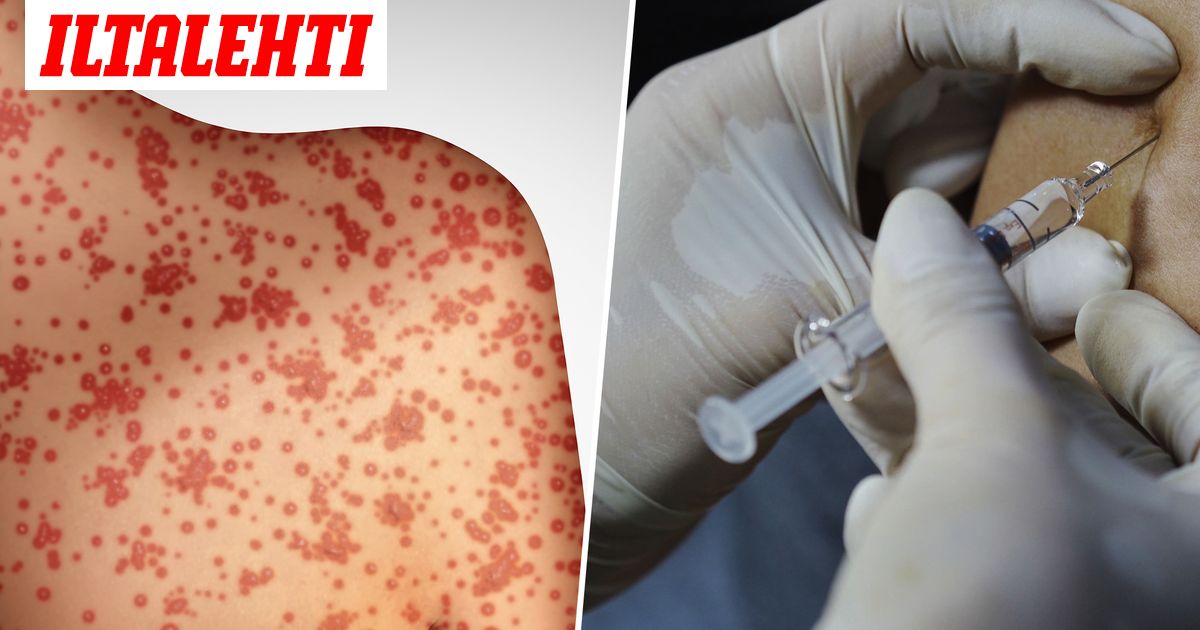 Tuhkarokko Suomessa: rokottamaton lapsi sairastui – 44–55-vuotiaat vaarassa