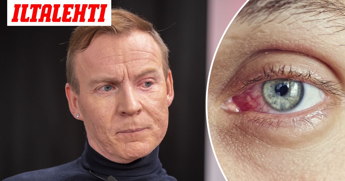 Tällainen on sidekalvon melanooma, johon Kimmo Blom kuoli