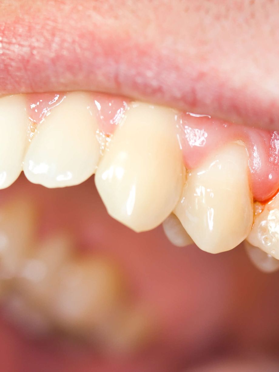 Väitöstutkimus: Nämä neljä ruokaa tuhoavat suomalaisnuorten hampaat