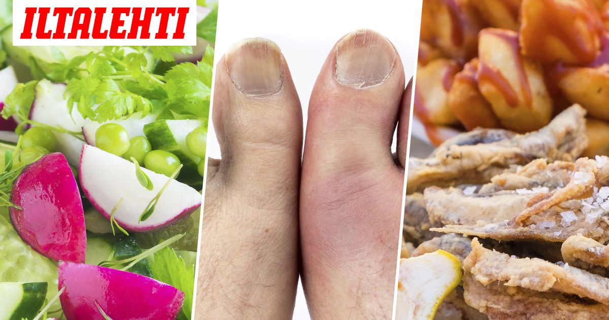 Kihti: oireet, hoito ja ehkäisy