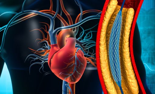 Pallolaajennus: valtimotukoksen syynä yleensä sepelvaltimotauti