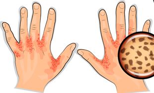 Syyhy voi tarttua jumppamatosta, mutta ei koirasta