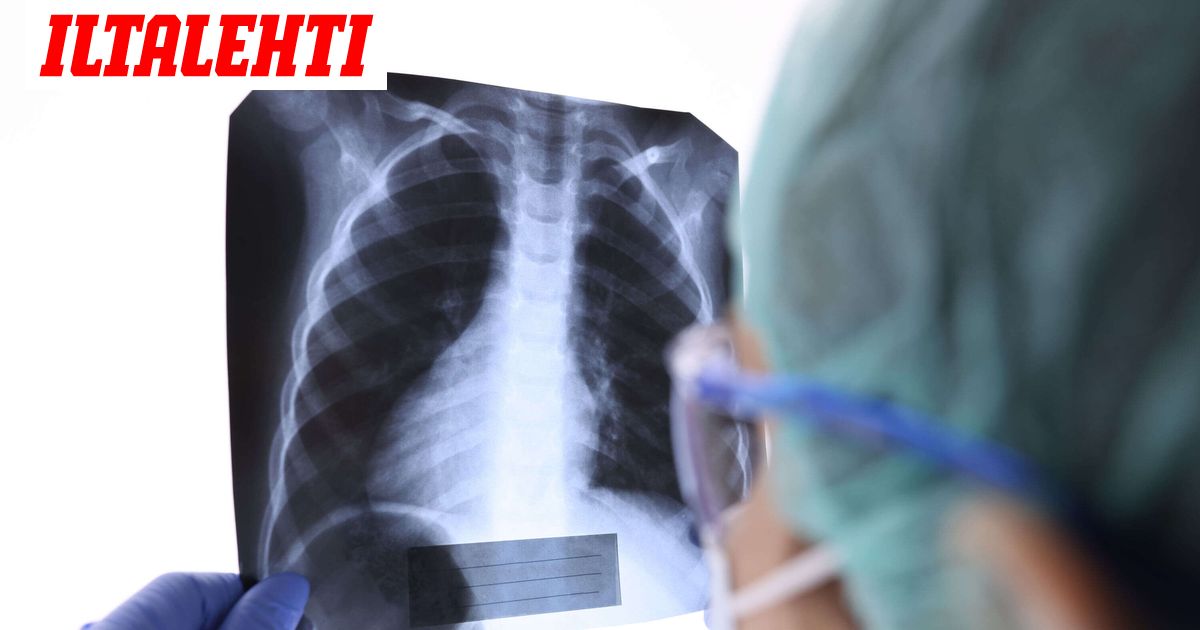 Elimiä vaurioittava sarkoidoosi voi sekoittua flunssaan