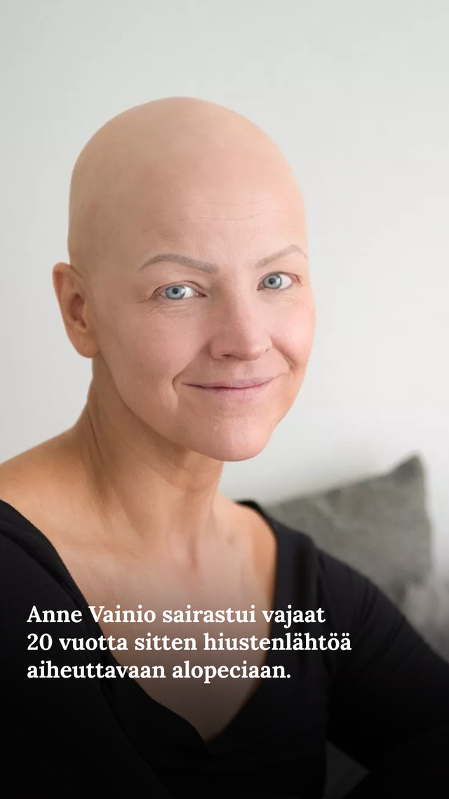 Anne Vainio sairastaa hiustenlähtöä aiheuttavaa alopeciaa | Iltalehti