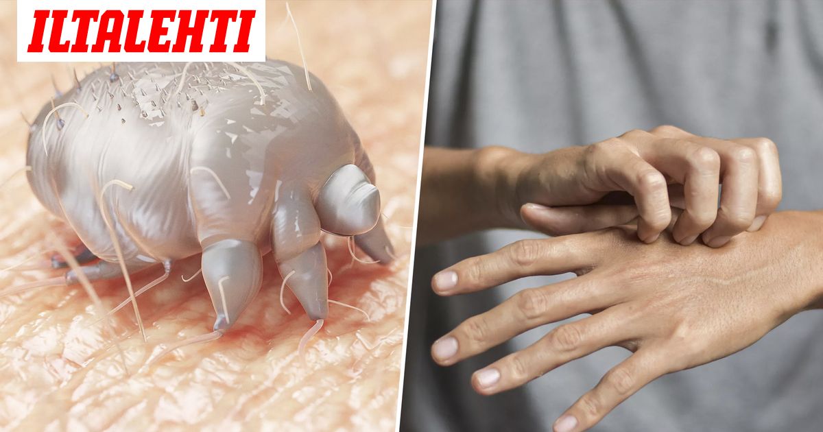 Syyhypunkki leviää hurjaa vauhtia – Nämä neljä asiaa siitä tulee tietää